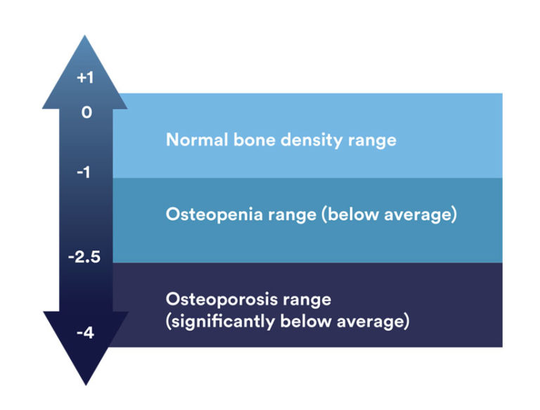 Osteoporosis — Treatment, Symptoms, & Bone Health