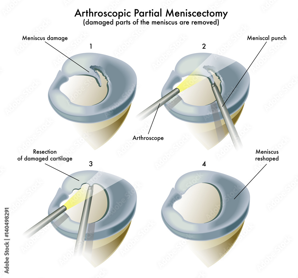 MeTeOR2 Clinical Trial - Musculoskeletal Health Australia (MHA)